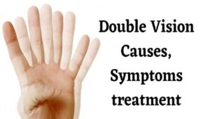 Double Vision (Diplopia): Causes, Symptoms & Treatment