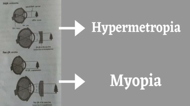 Vision impairment – Myopia, Hyperopia, Presbyopia
