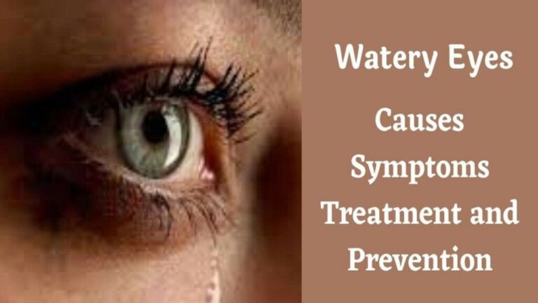 Watery Eyes – Causes, Symptoms, Treatment and Prevention