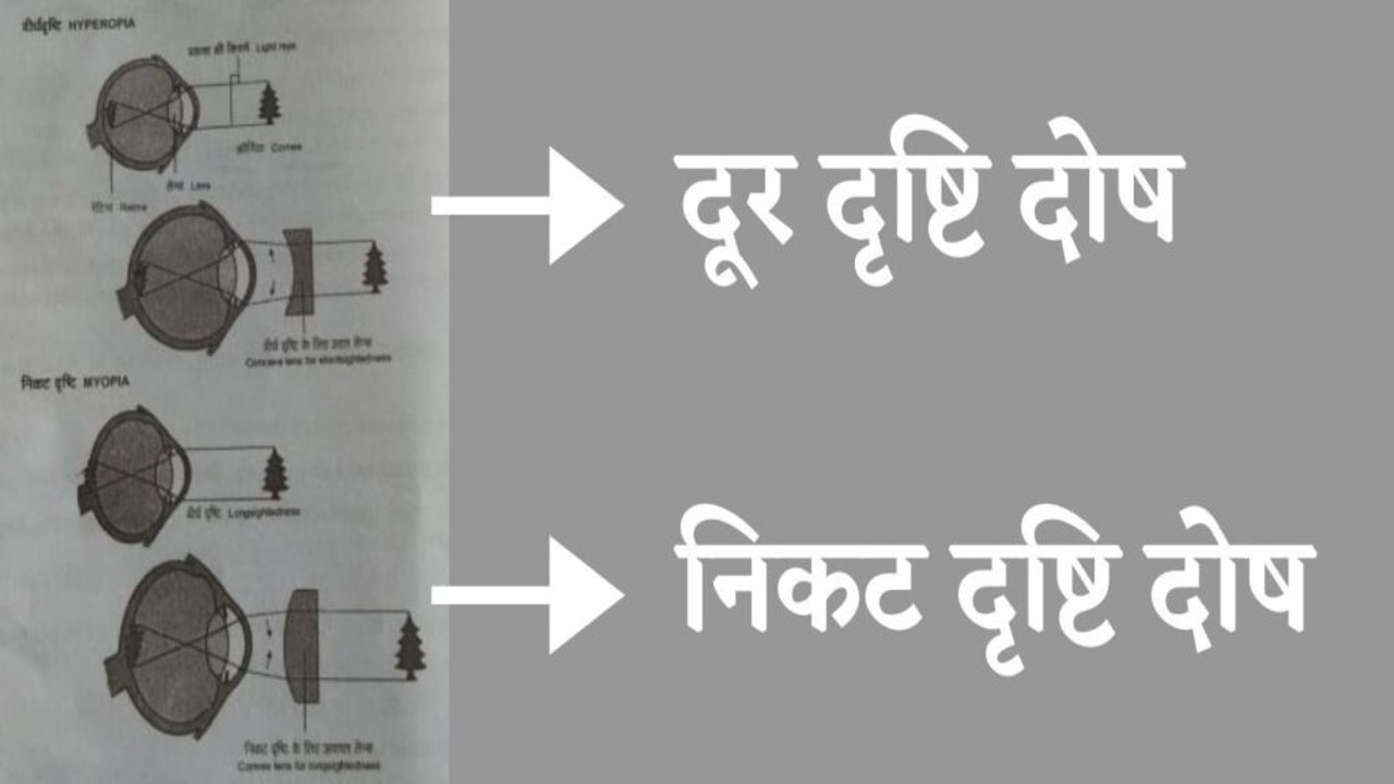 Visual Impairment In Hindi Visual Impairment In Hindi